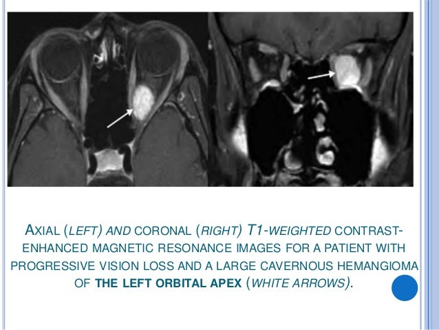 Anatomy of the orbit