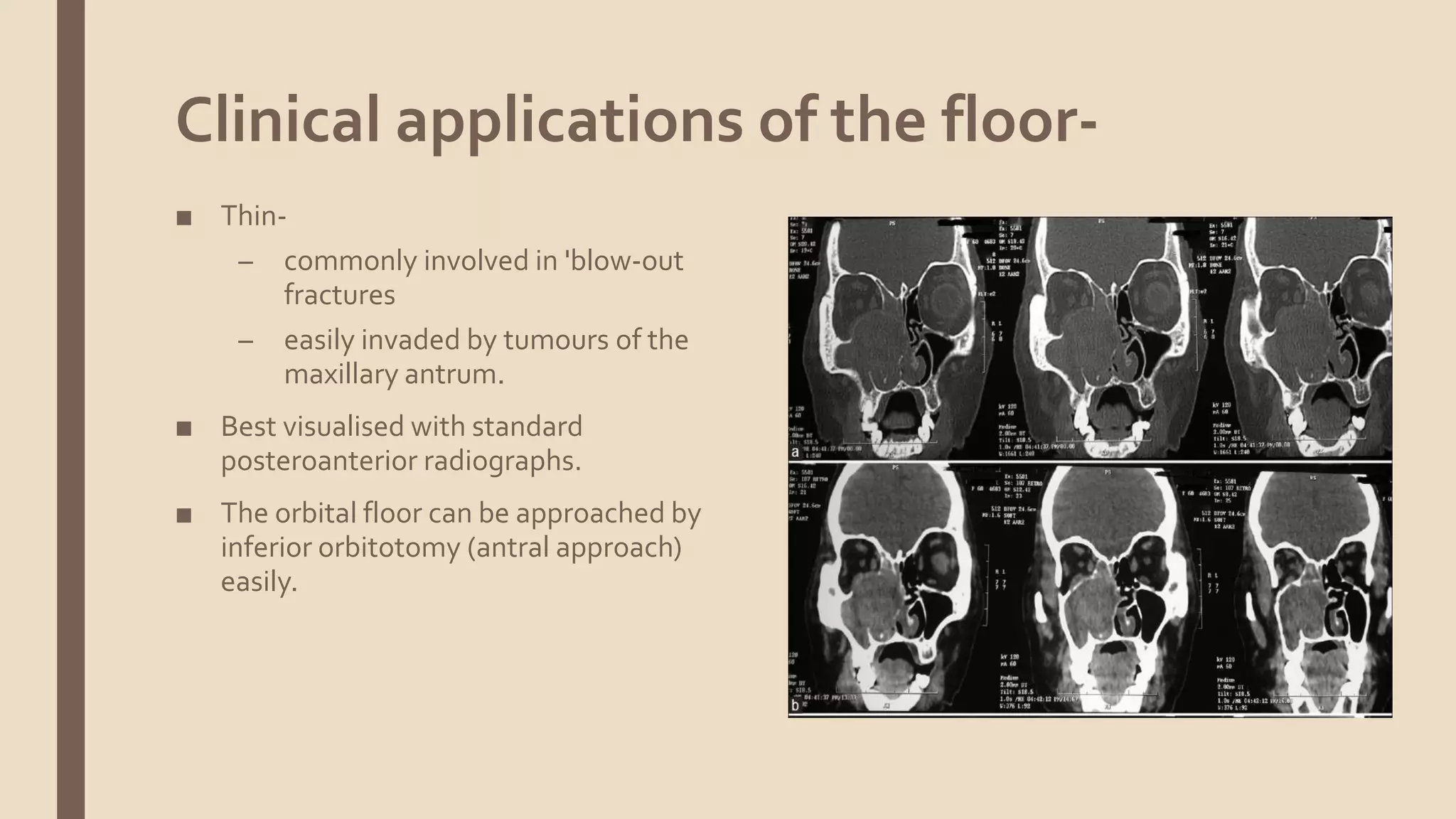 Anatomy of the orbit | PPTX