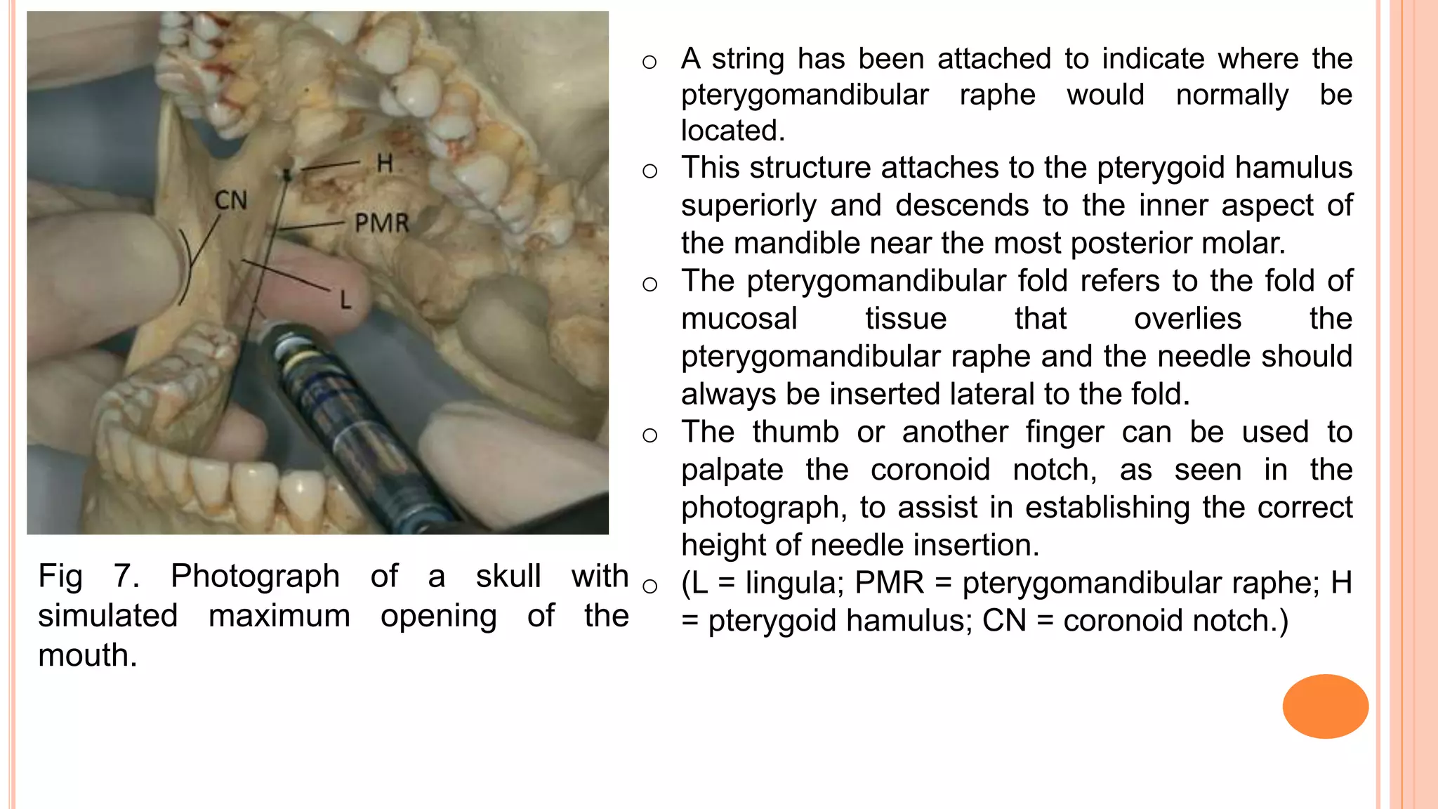 Anatomy of the pterygomandibular space and its clinical significance | PPTX