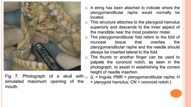Anatomy of the pterygomandibular space and its clinical significance | PPTX