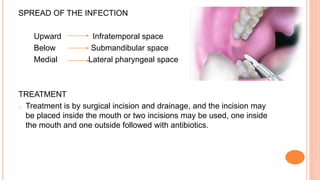 Pterygomandibular Space Infection