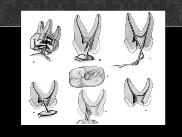 Anatomy of the pulp space and access cavity | PPTX | Dental Health ...