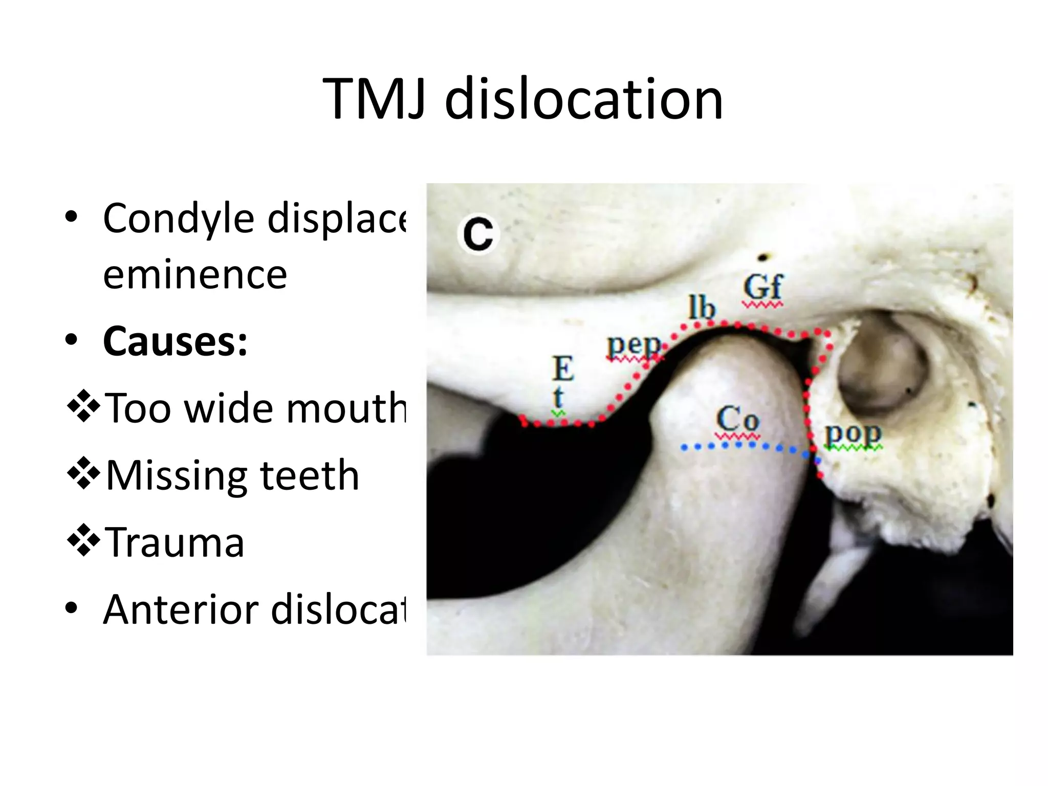 Anatomy of TMJ | PDF