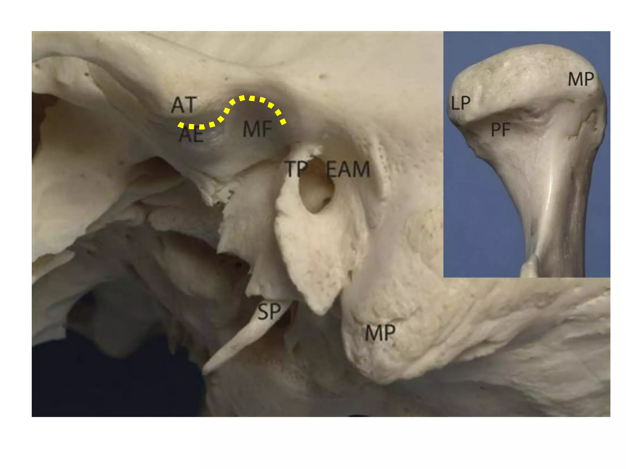 Anatomy of TMJ | PDF
