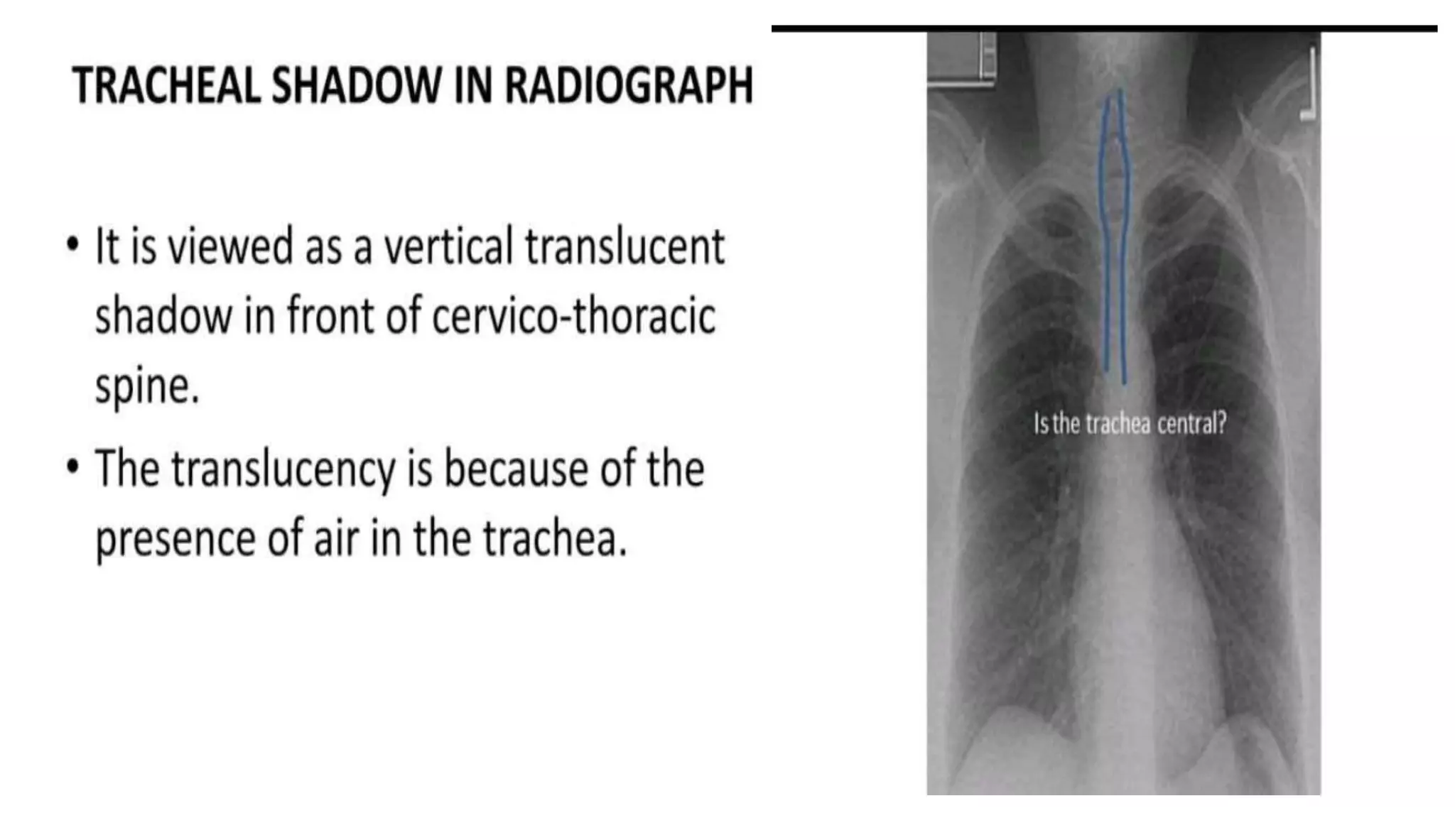 anatomy of trachea.pptx