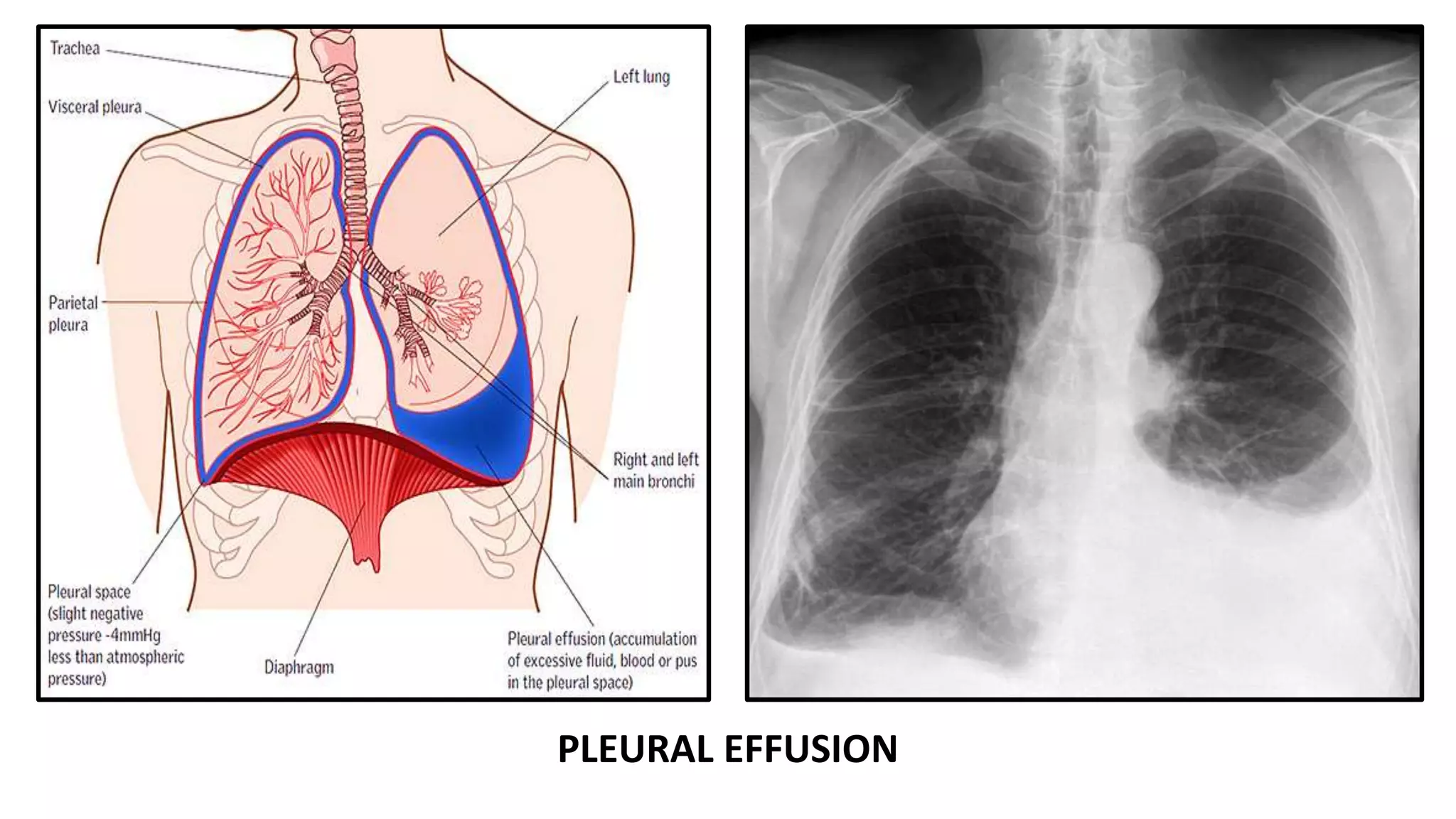ANATOMY OF TRACHEA, BRONCHI & PLEURA.pptx
