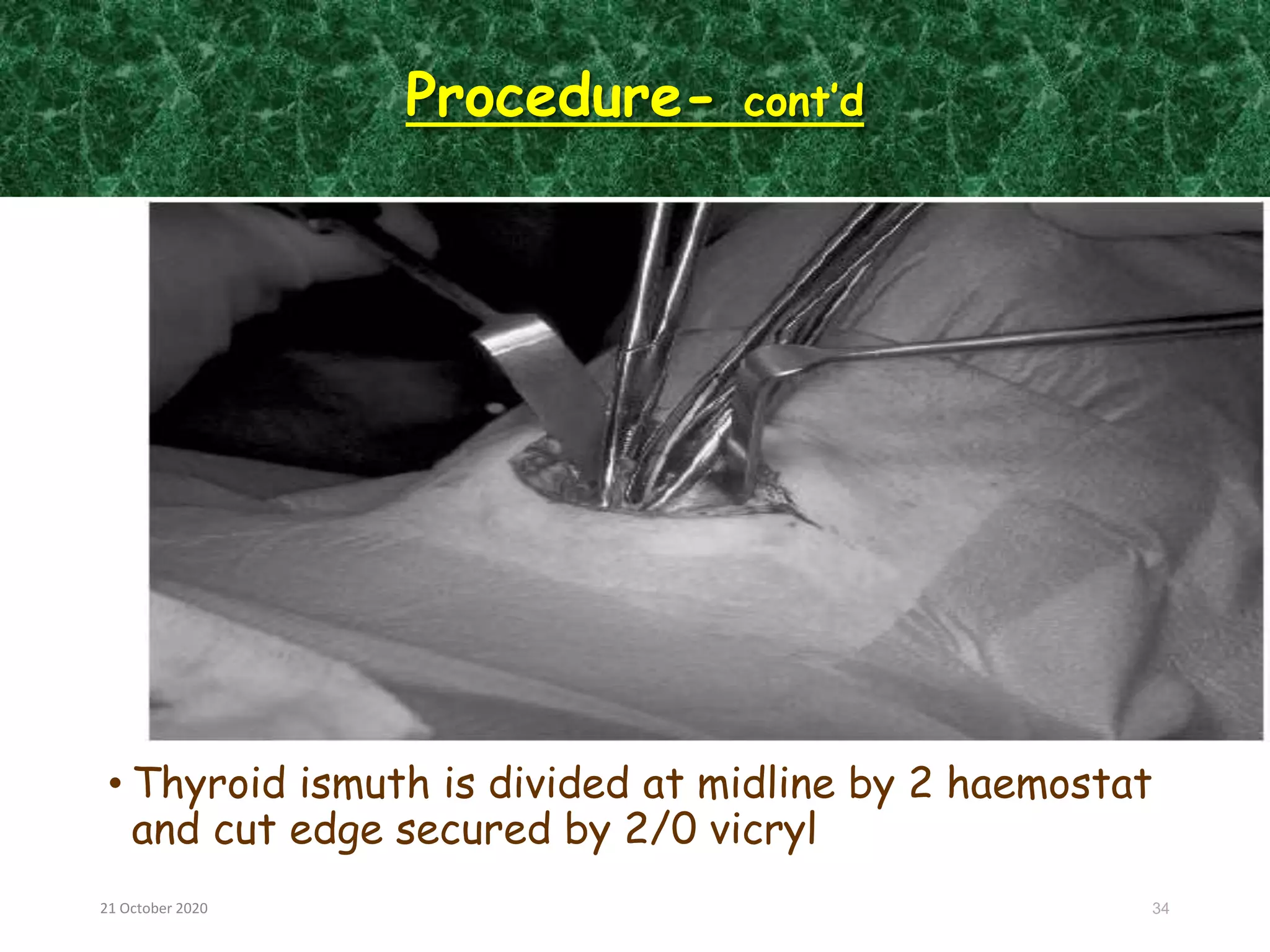 Anatomy of trachea & tracheostomy ----- | PPT