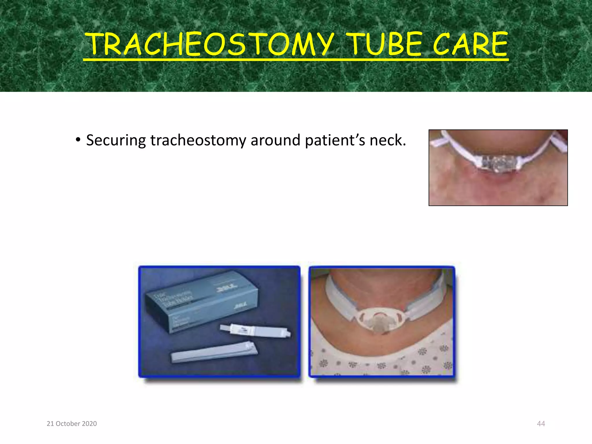 Anatomy of trachea & tracheostomy ----- | PPT