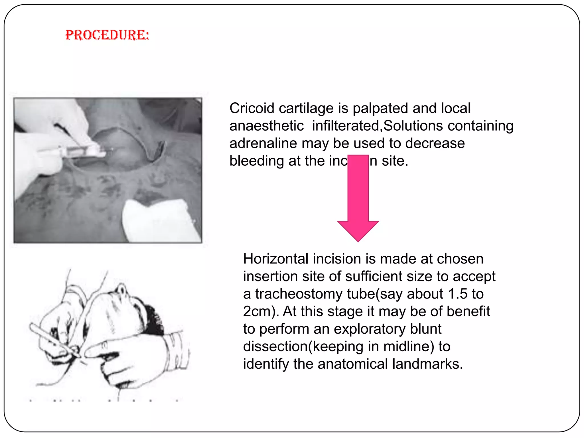 Anatomy of tracheobronchial tree | PPTX