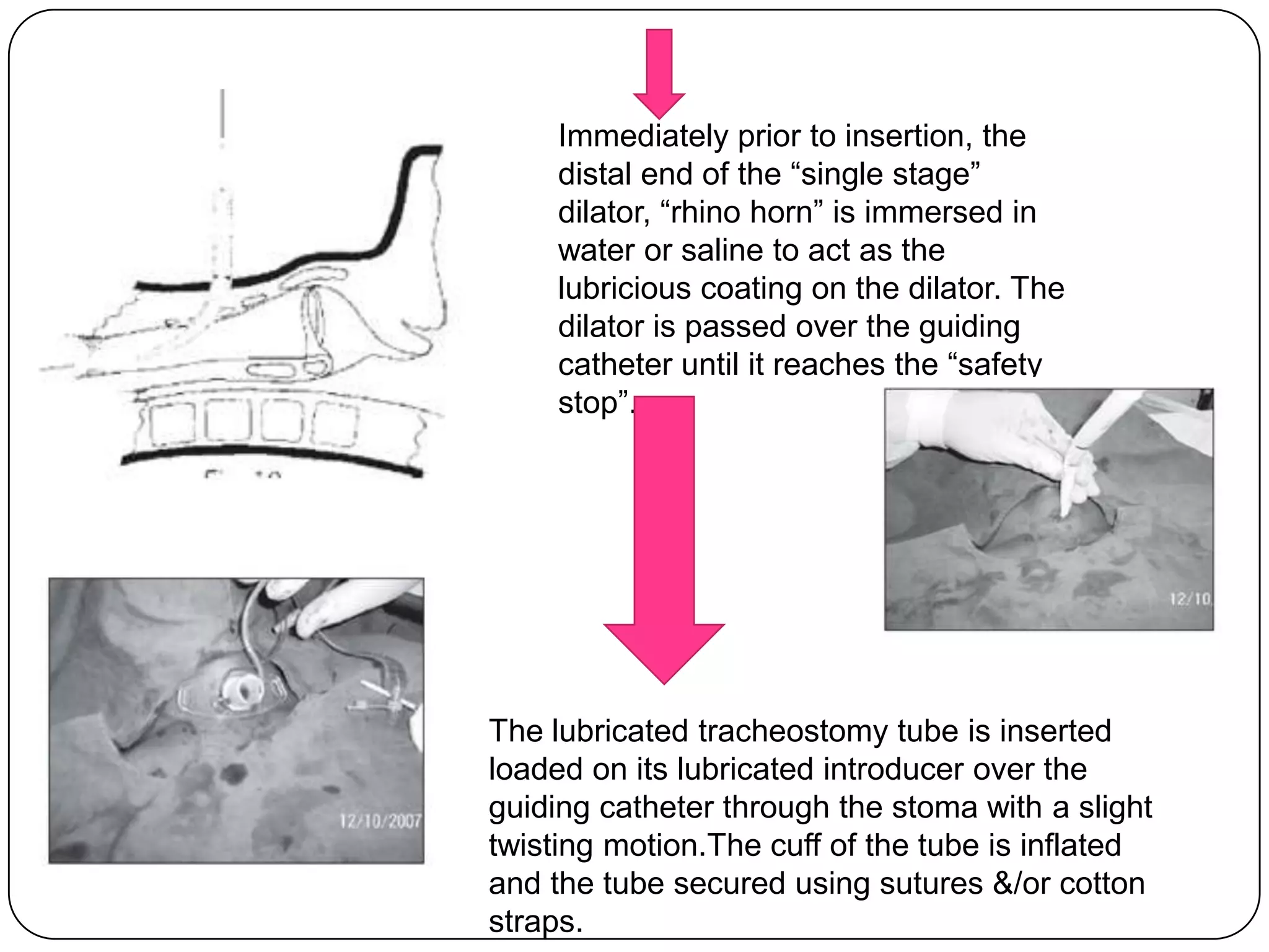 Anatomy of tracheobronchial tree | PPTX