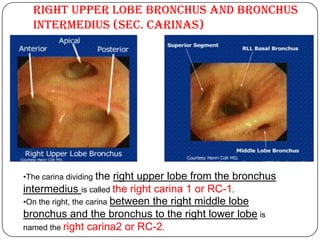 Anatomy of tracheobronchial tree | PPTX