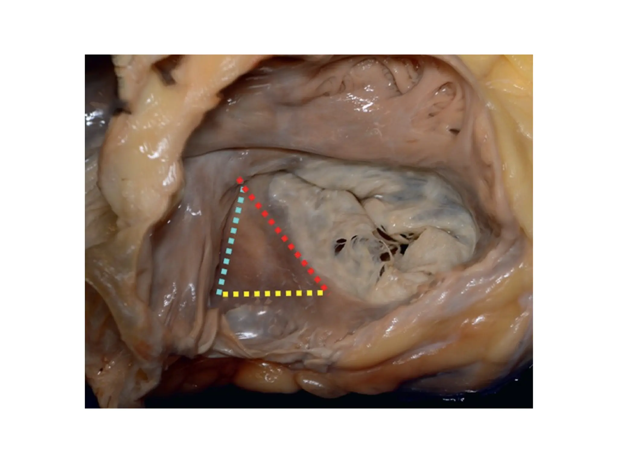 Anatomy Of Tricuspid Valve Dr Garv Ameta Pptx
