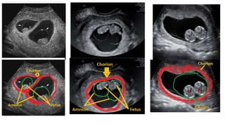 Anatomy of twin pregnancy | PPTX