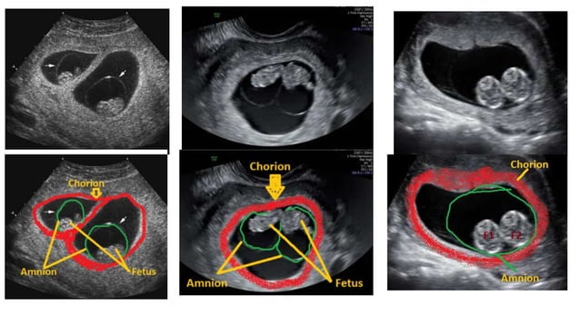 Anatomy of twin pregnancy | PPT