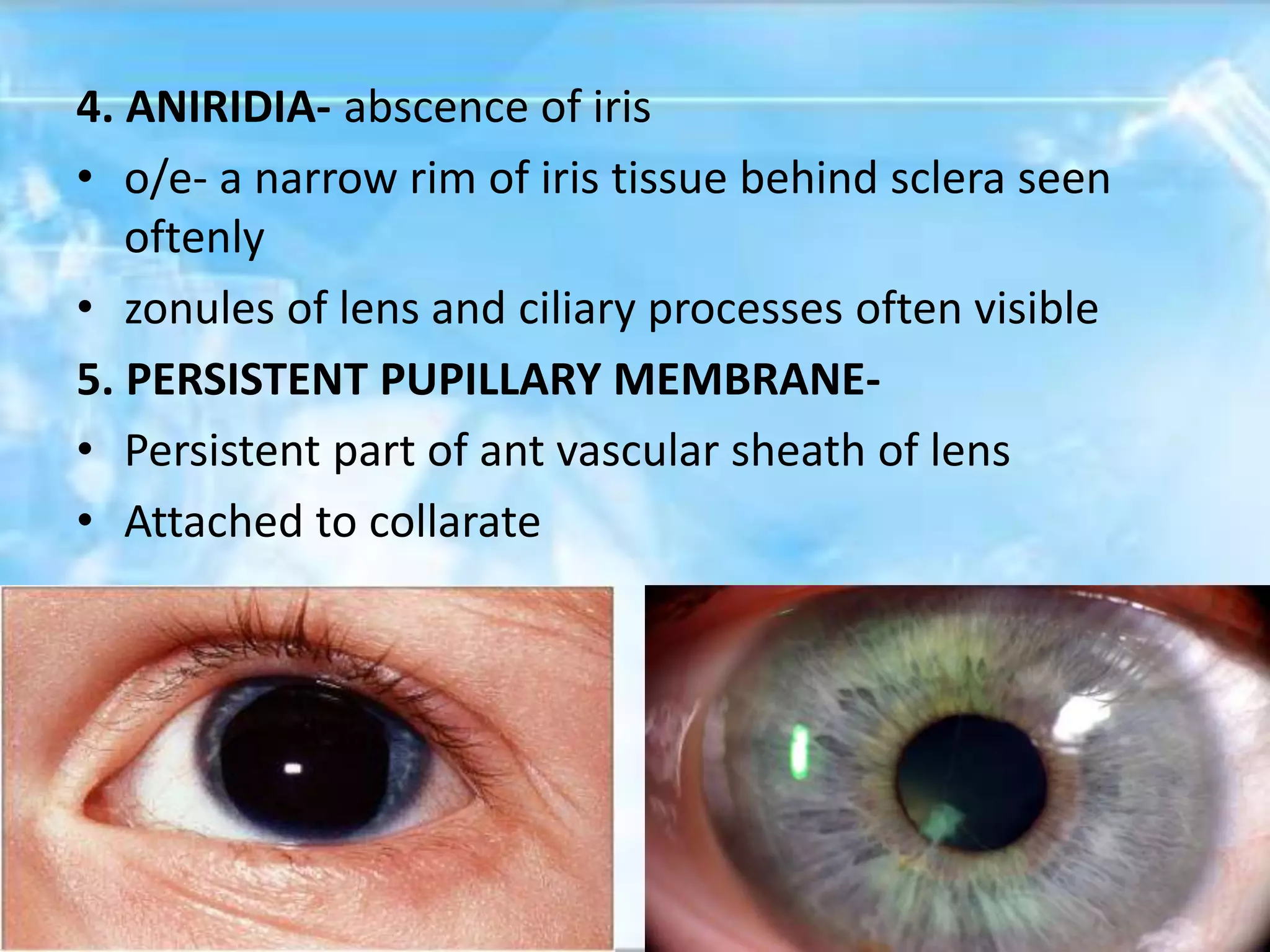 Anatomy of uvea | PPTX