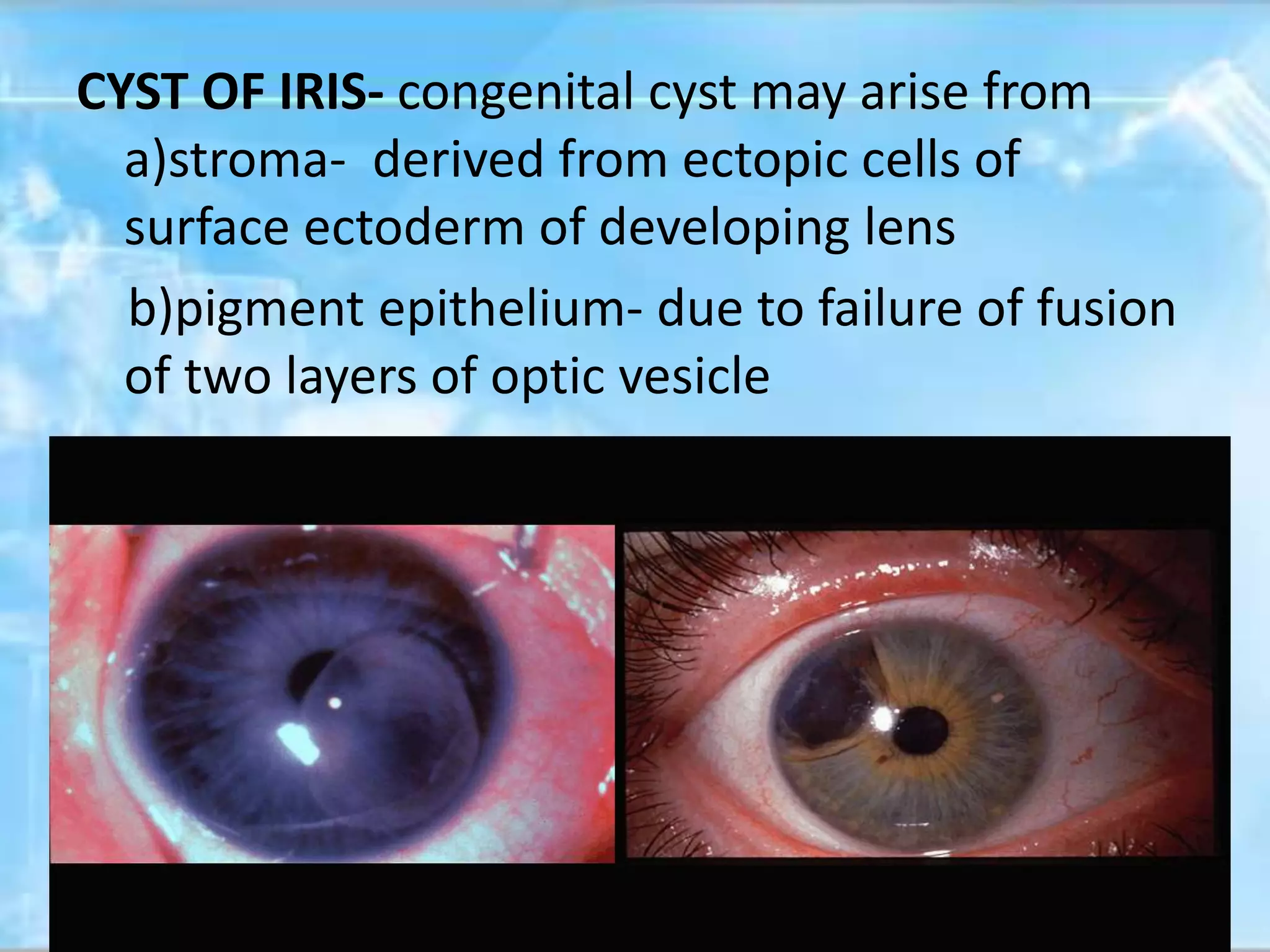 #ANATOMY OF UVEA (IRIS, CILLIARY BODY, CHOROID) | PDF