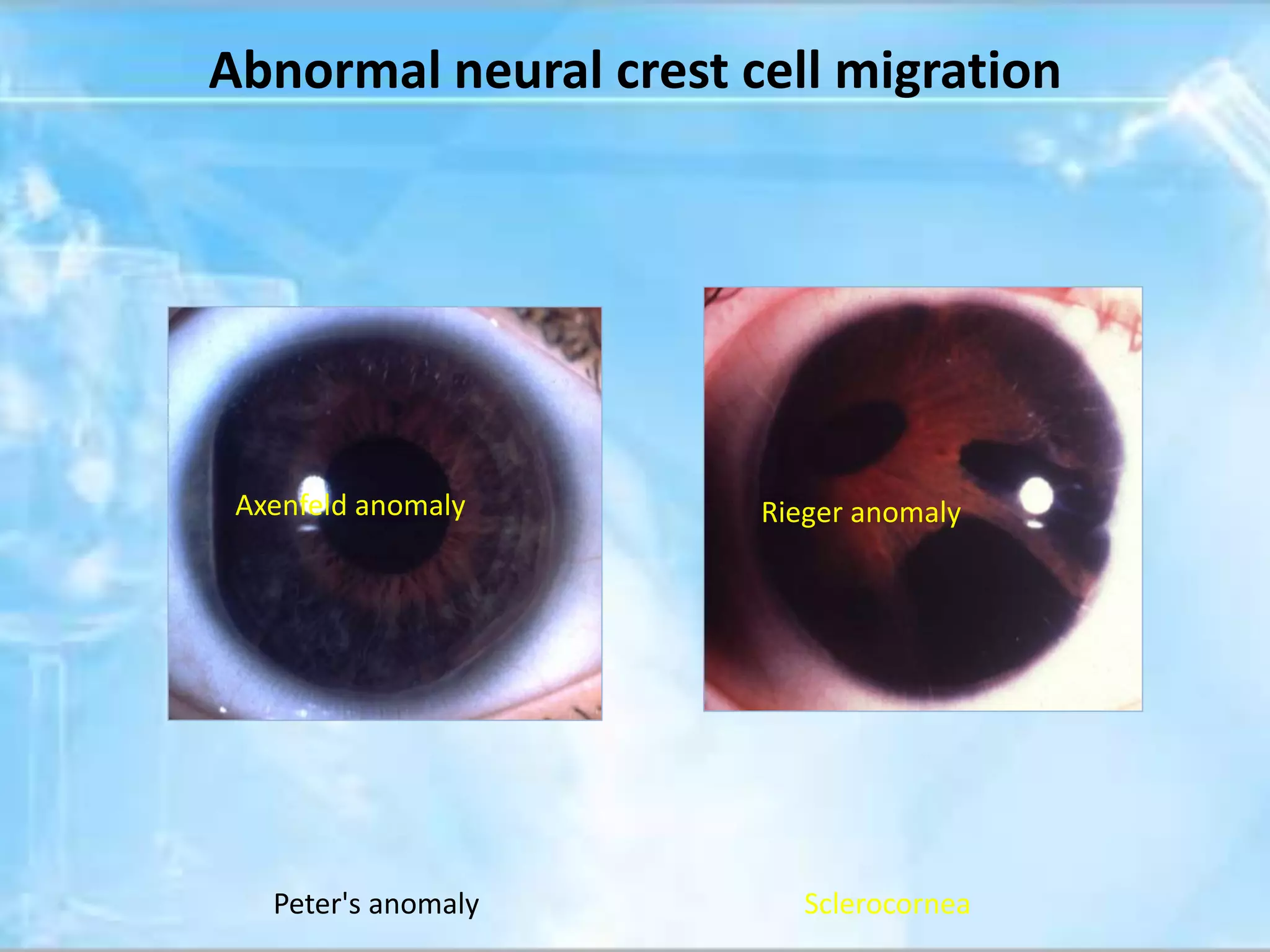 #ANATOMY OF UVEA (IRIS, CILLIARY BODY, CHOROID) | PDF