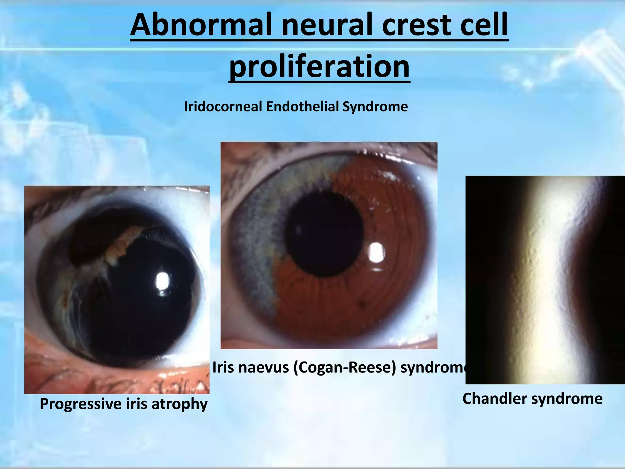 #ANATOMY OF UVEA (IRIS, CILLIARY BODY, CHOROID) | PDF
