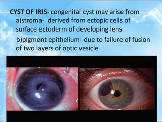 Iris Cyst Human
