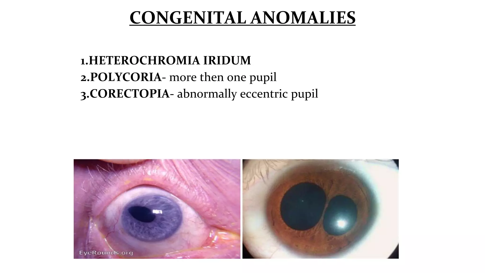 Anatomy of uvea | PPTX