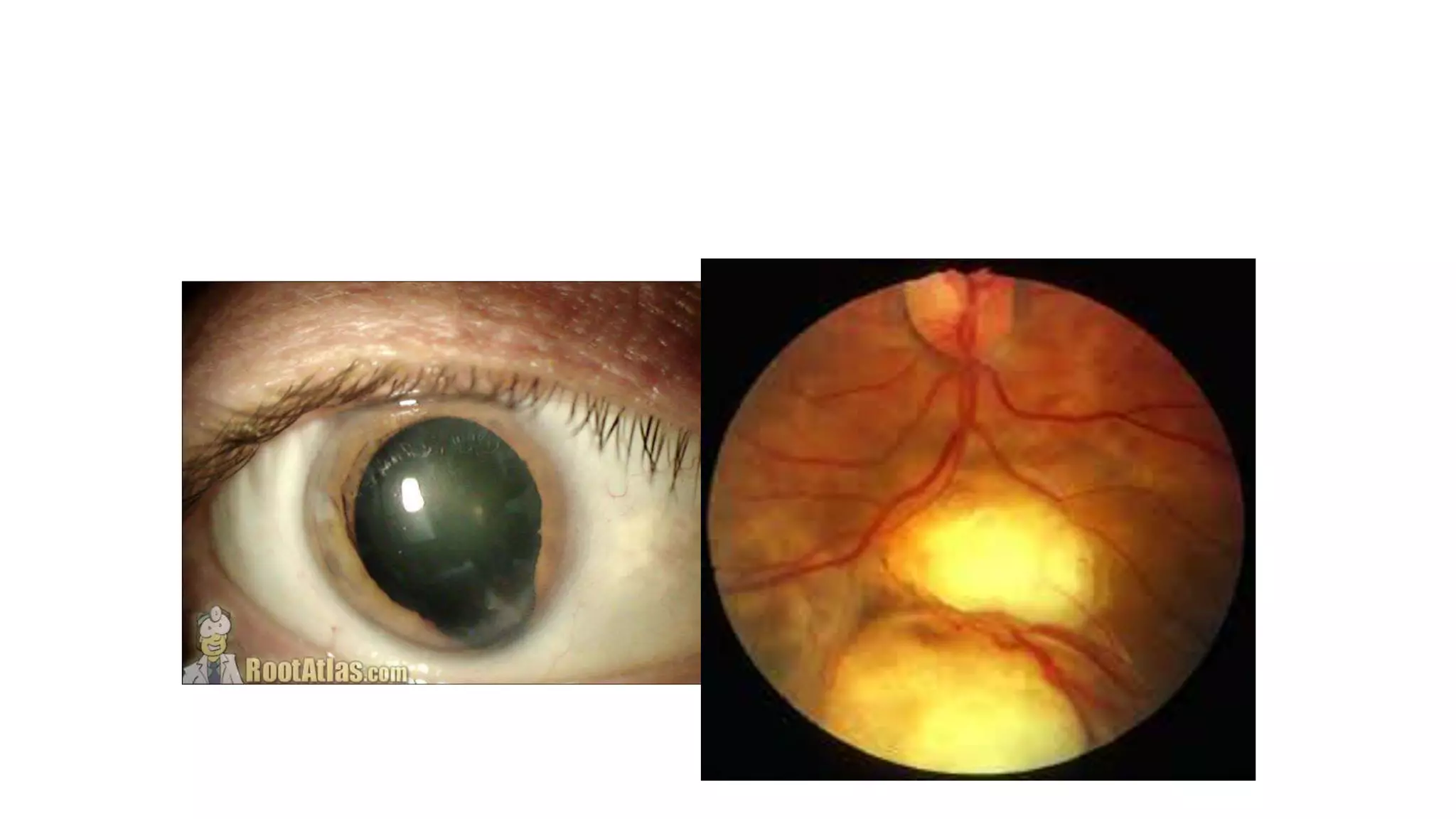 Anatomy of uvea | PPTX