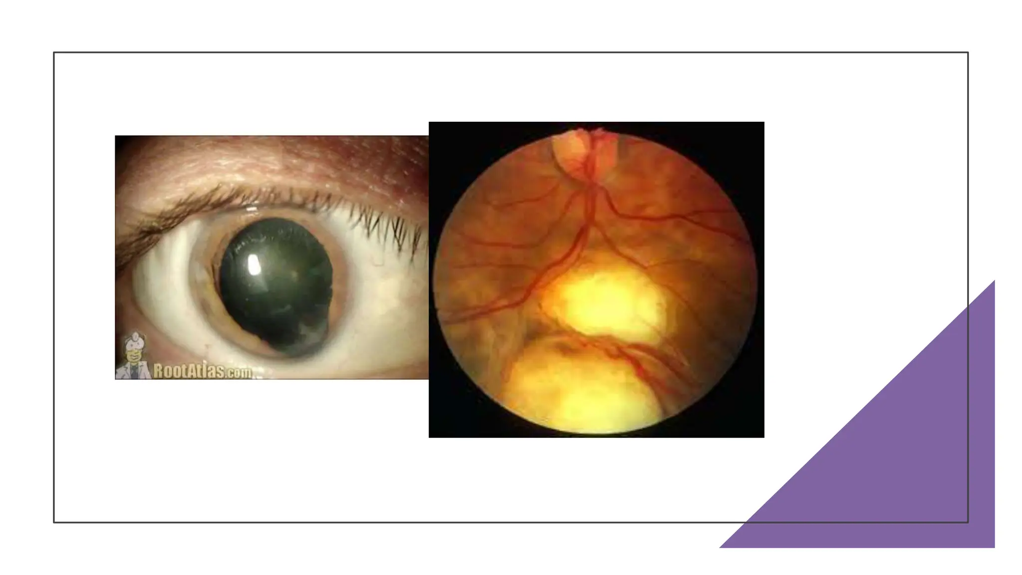 anatomyofuvea , iris , ciliary body , choroid | PPTX | Eye and Vision ...