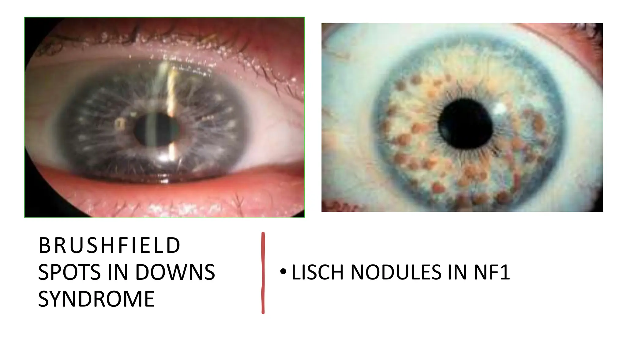 anatomyofuvea , iris , ciliary body , choroid | PPTX | Eye and Vision ...