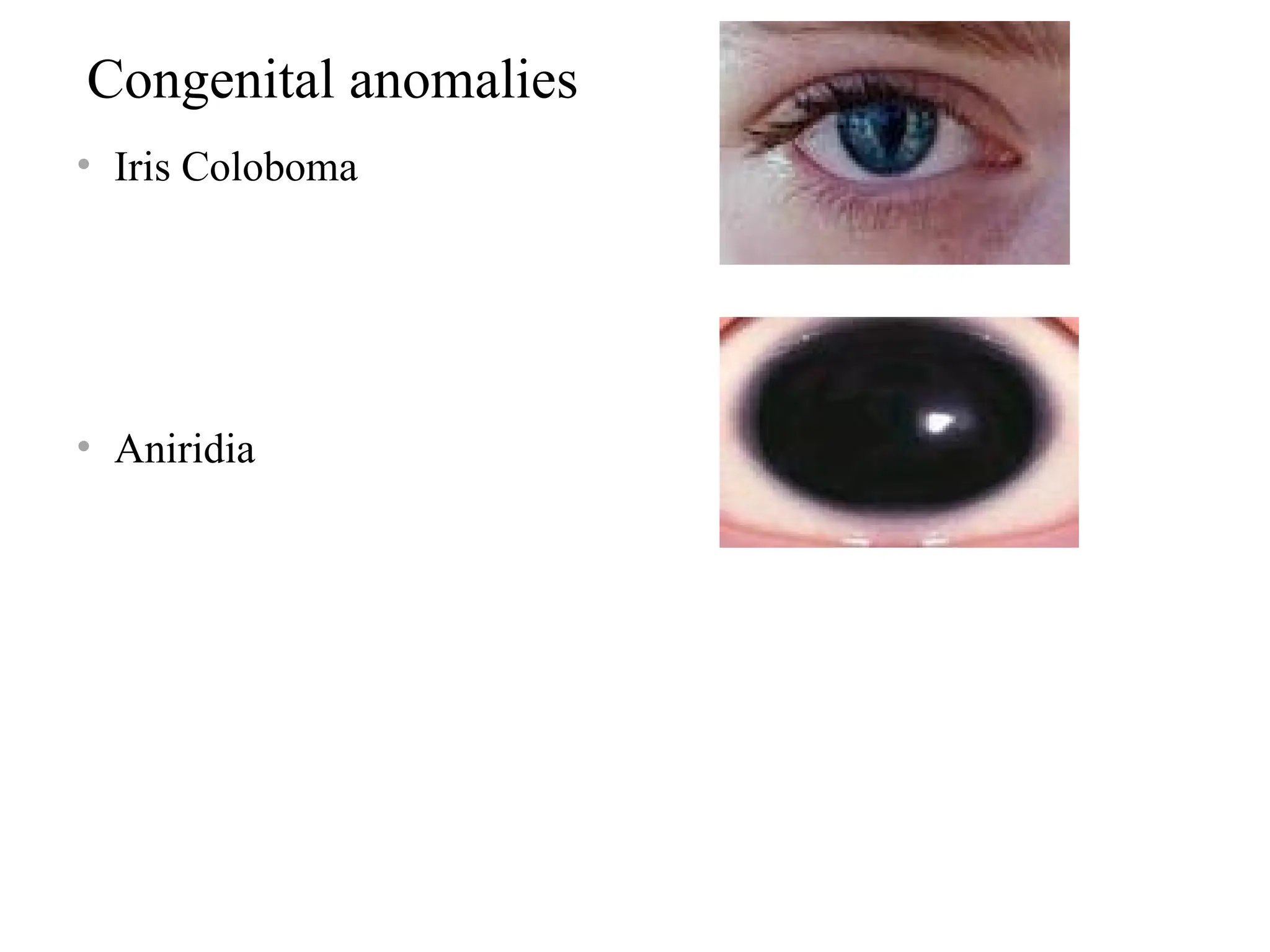 Anatomy of uvea and mechanism of uveitis.ppt