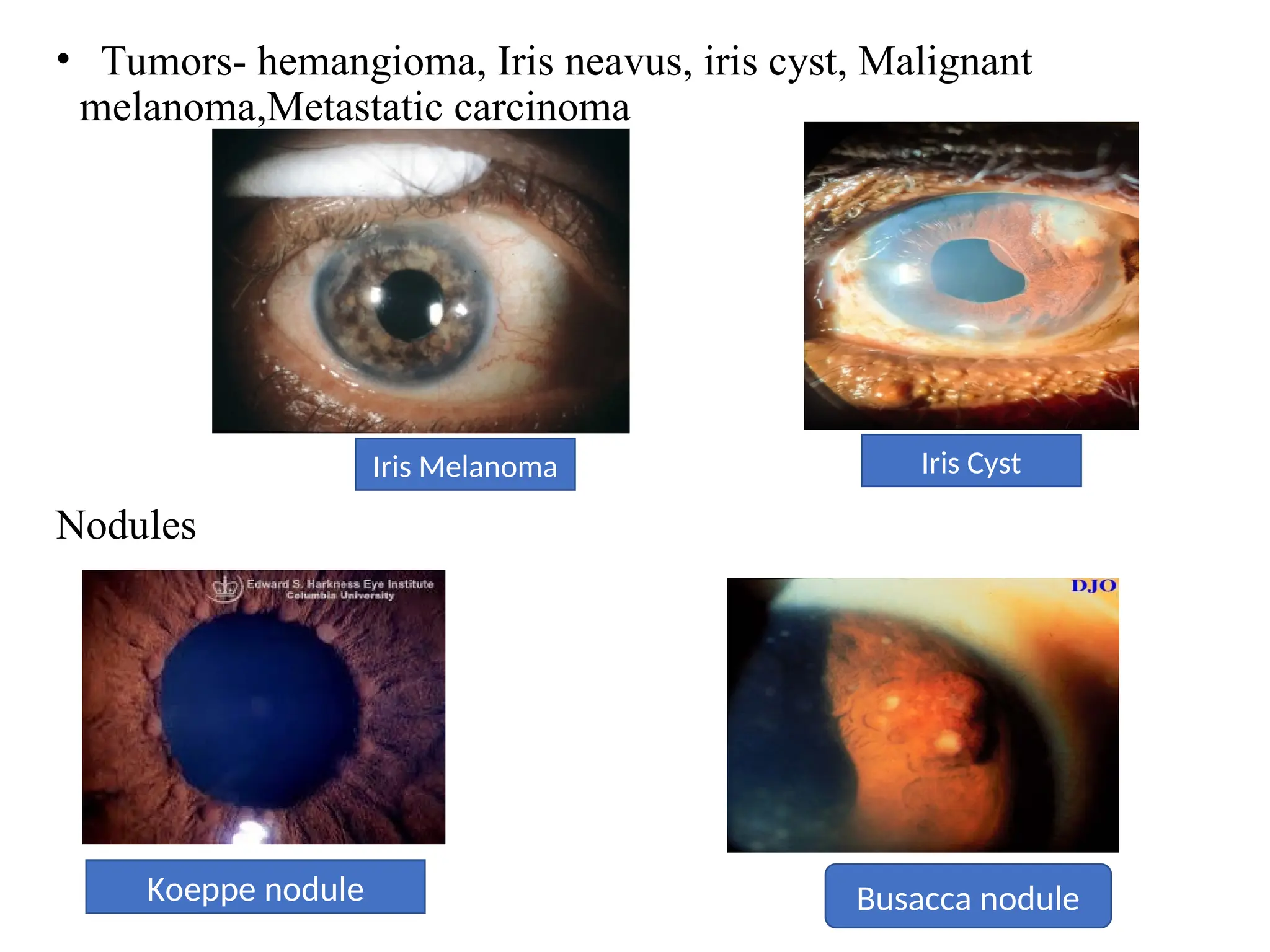 Anatomy of uvea and mechanism of uveitis.ppt