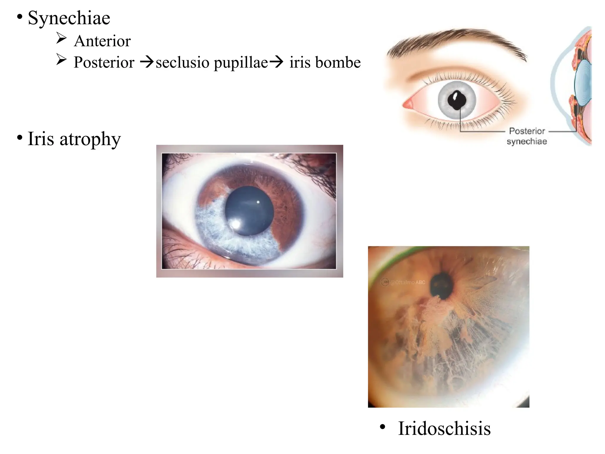 Anatomy of uvea and mechanism of uveitis.ppt