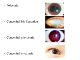 Anatomy of uvea and mechanism of uveitis.ppt