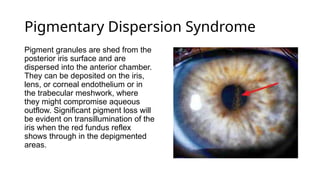 Anatomy of uveal tract and everything else about it | PPTX