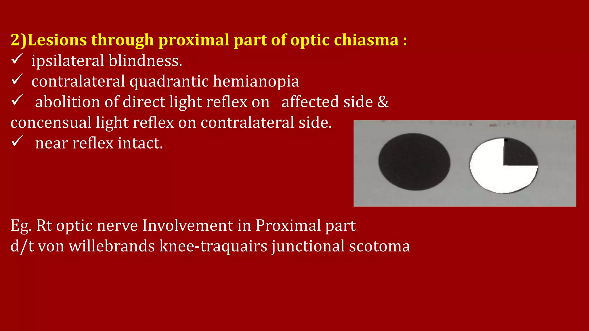Anatomy OF VISUAL PATHWAY | PPTX