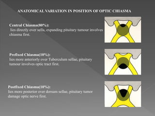 Anatomy of visual pathway and its lesion.pptx