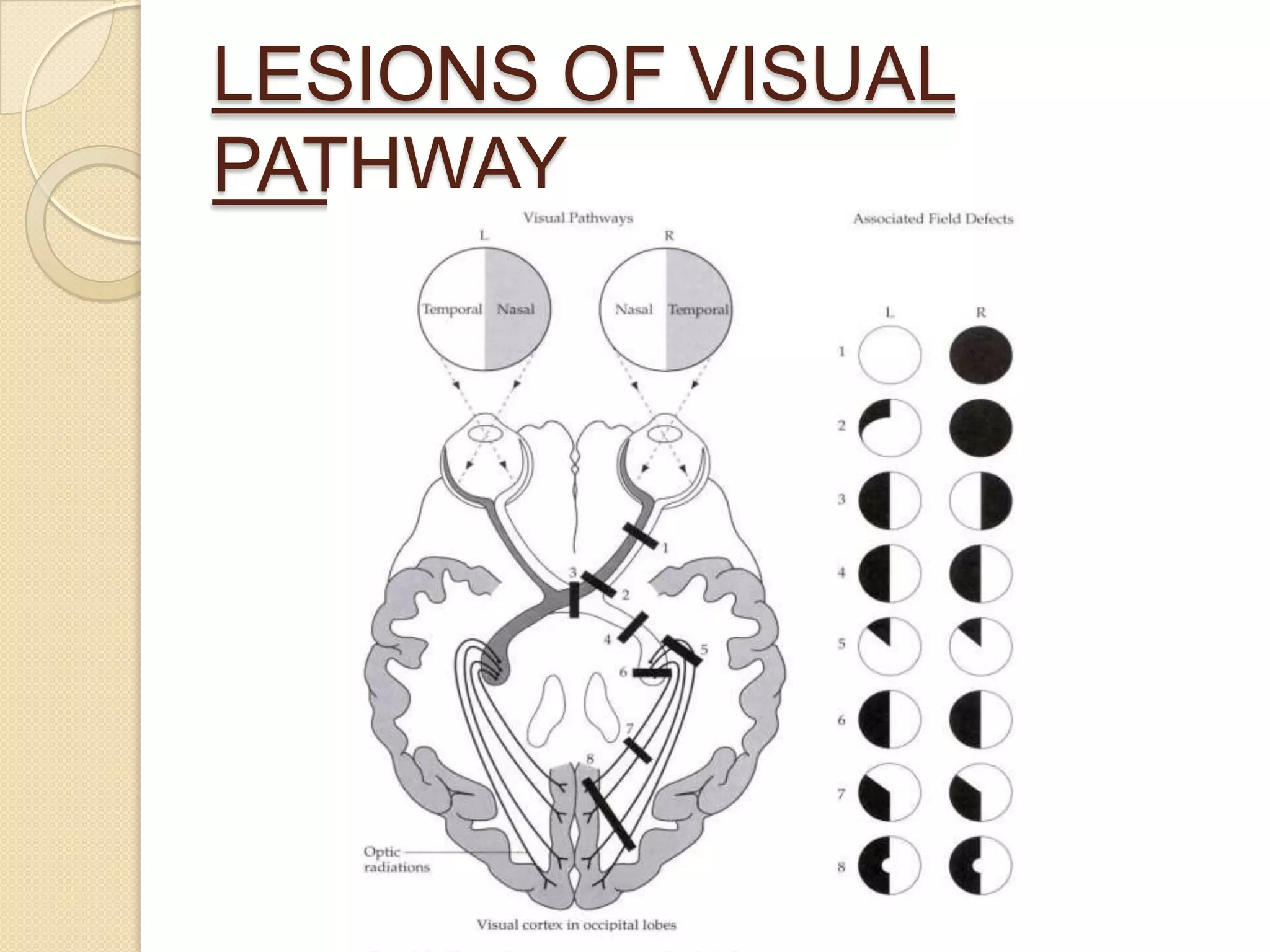 Anatomy of visual pathway and its lesions. | PPTX