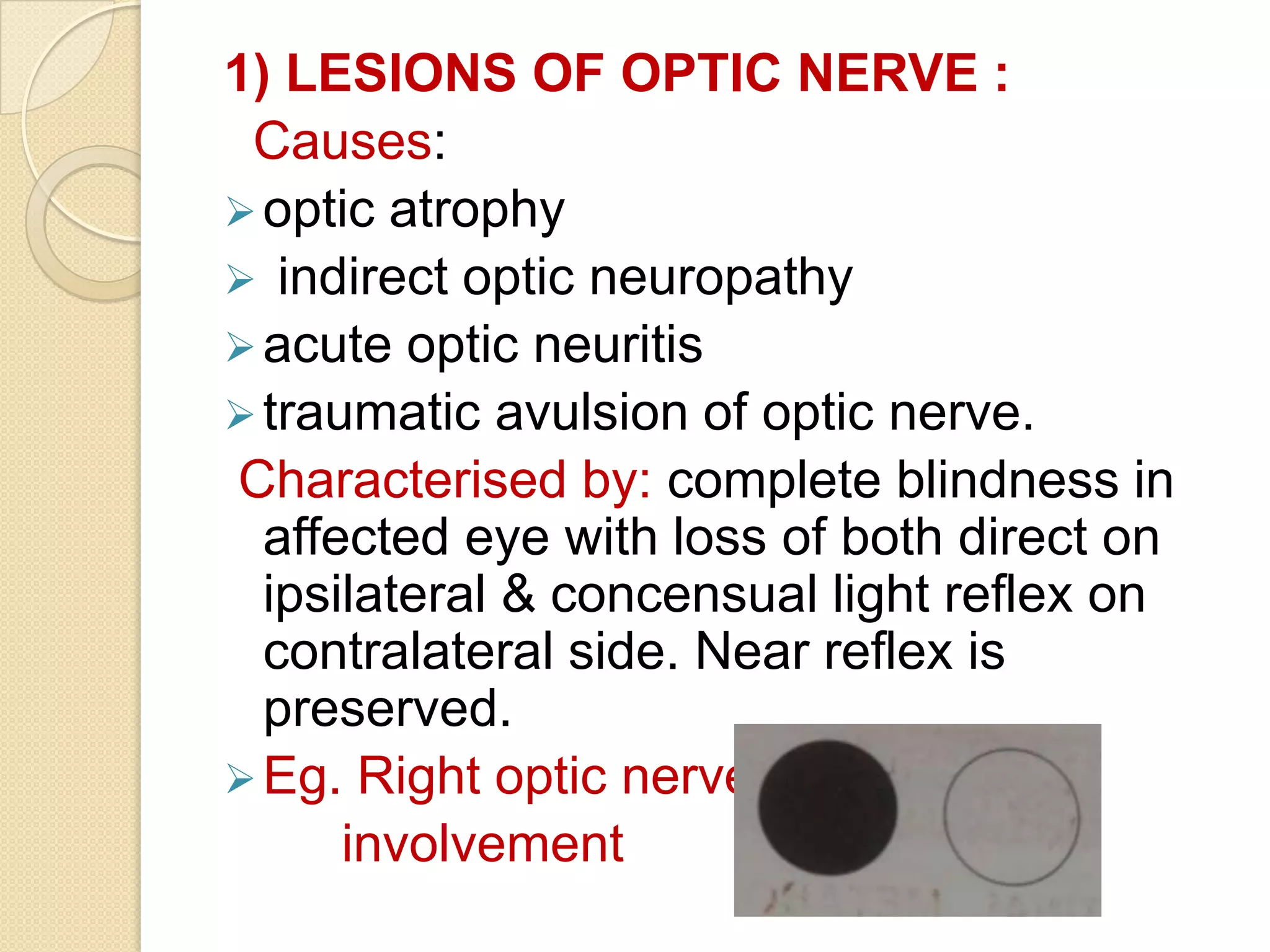 Anatomy of visual pathway and its lesions. | PPTX