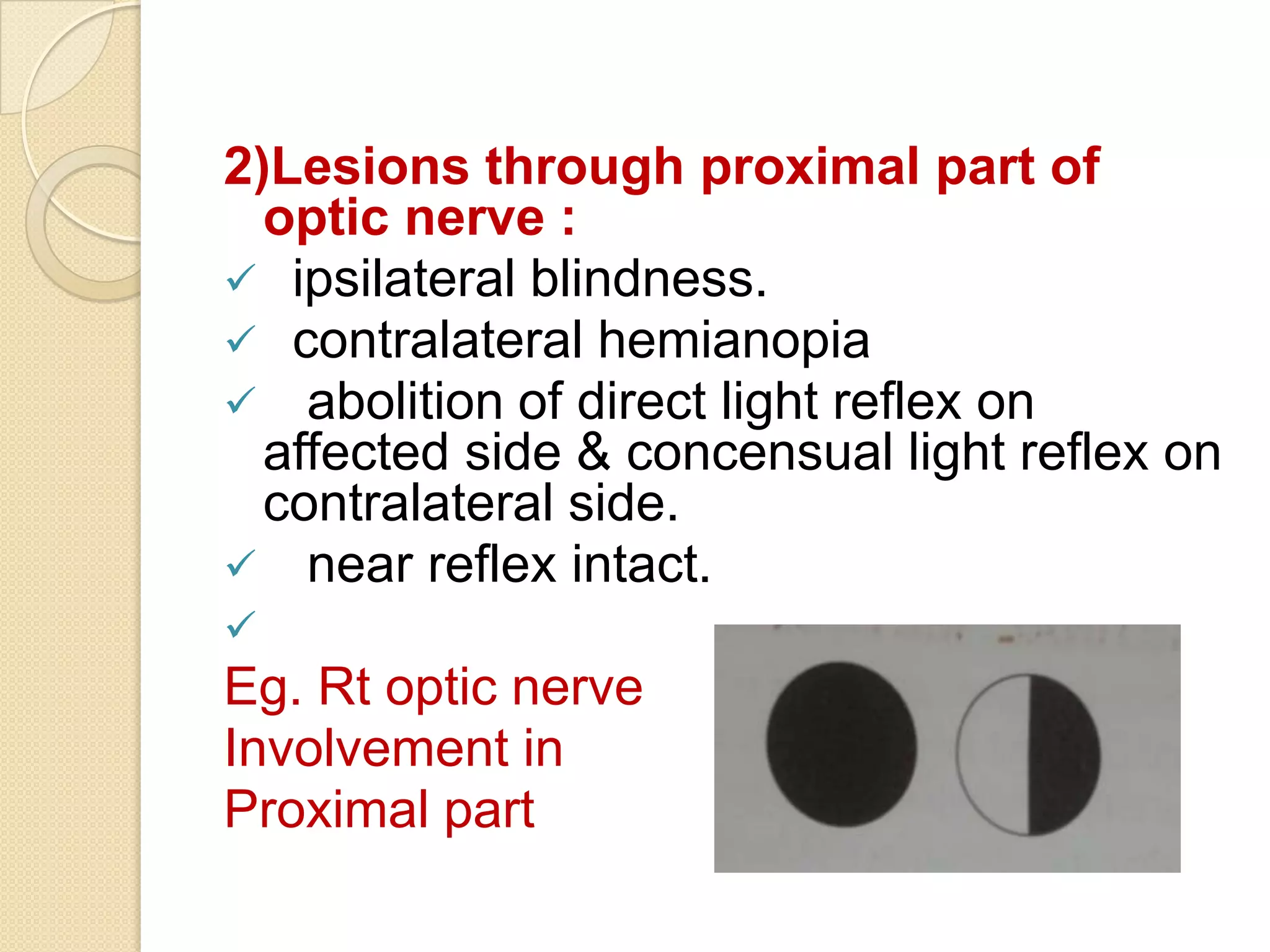 Anatomy of visual pathway and its lesions. | PPTX