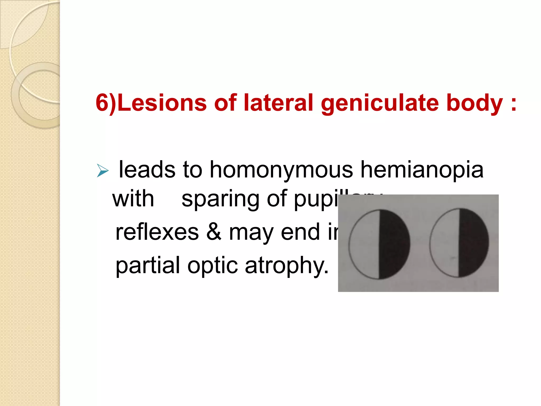 Anatomy of visual pathway and its lesions. | PPTX