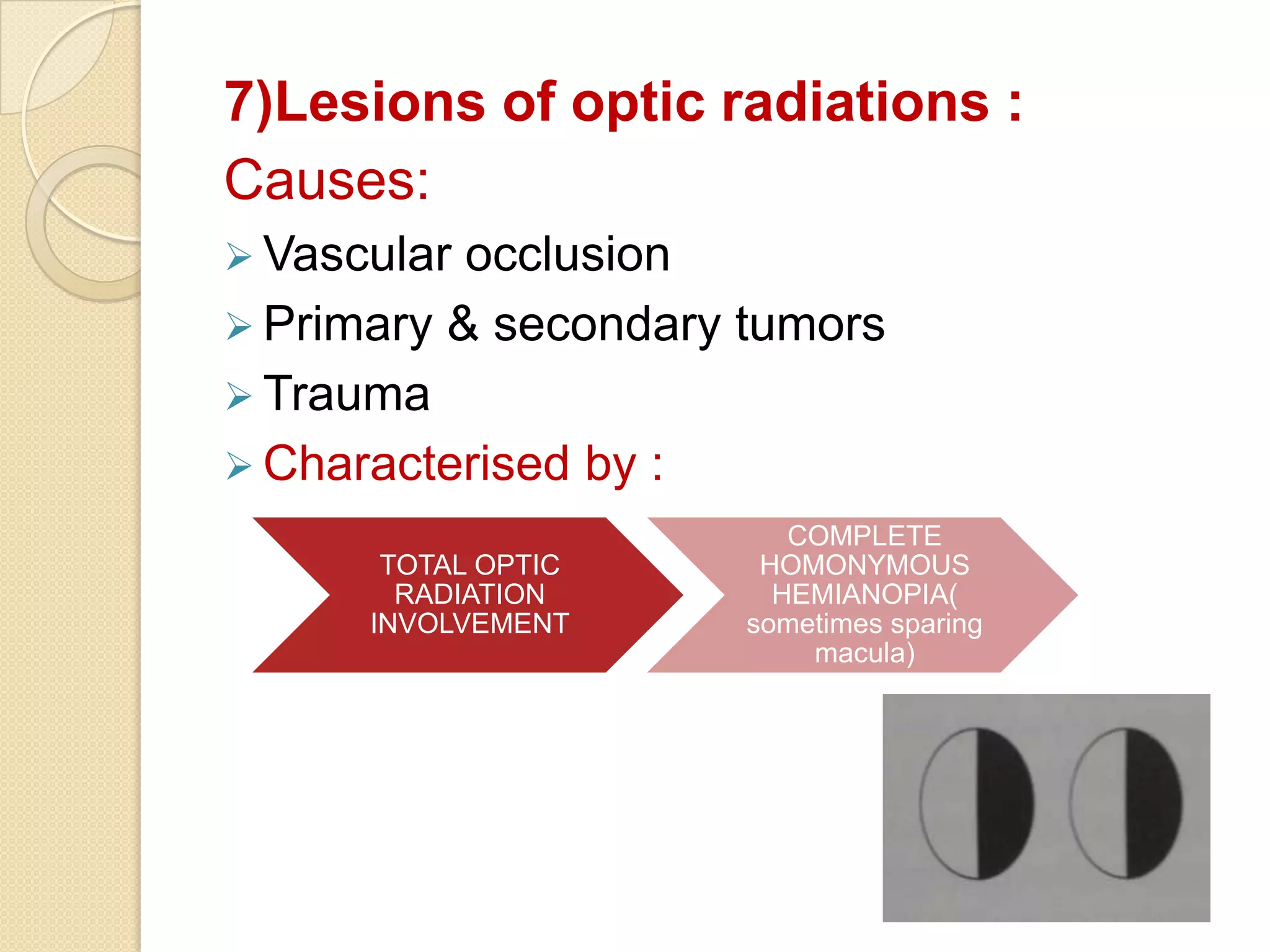 Anatomy of visual pathway and its lesions. | PPTX