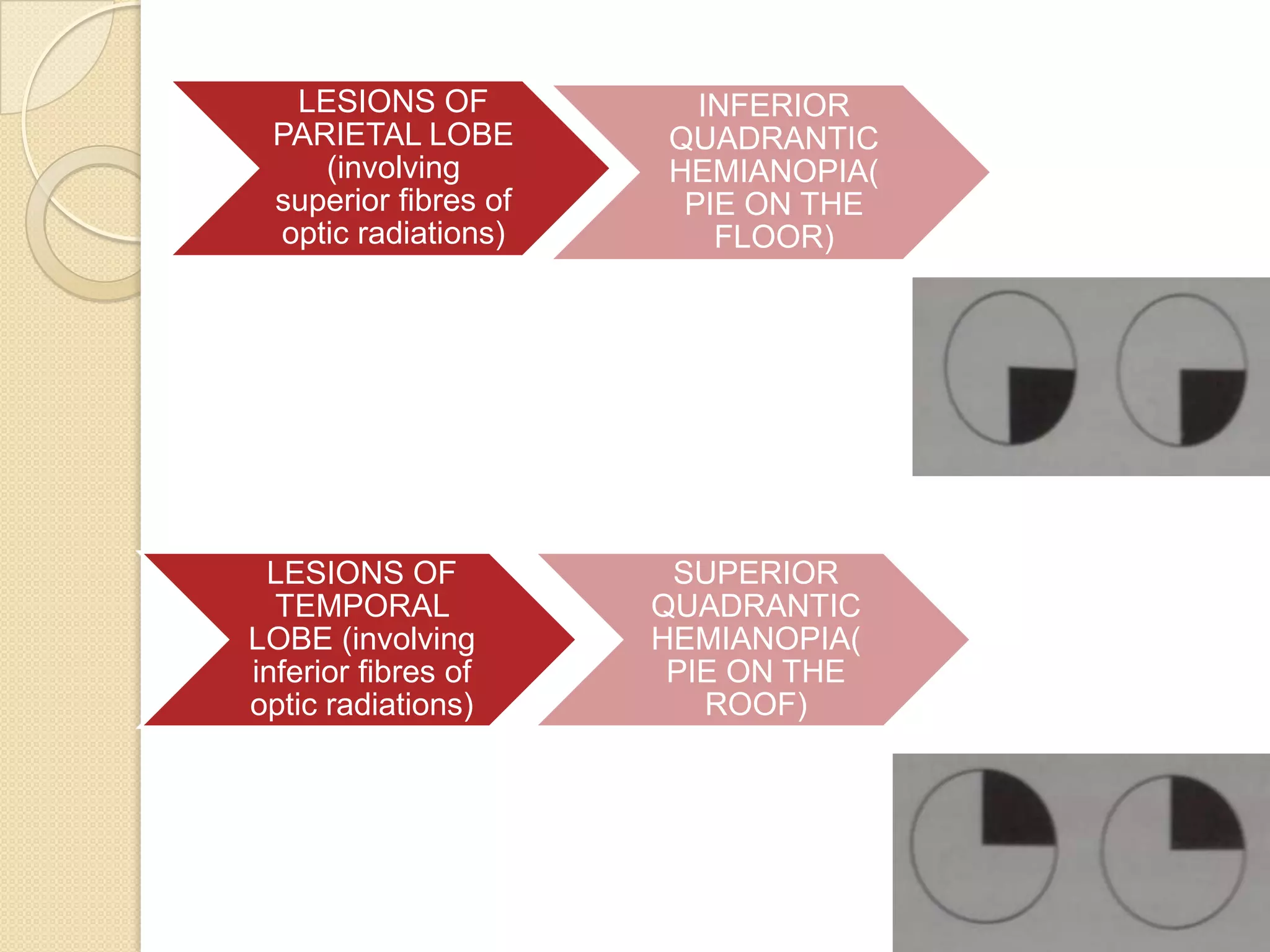 Anatomy of visual pathway and its lesions. | PPTX