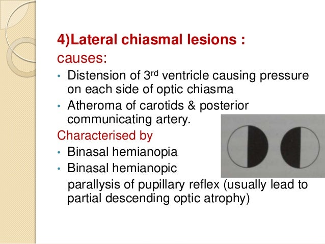 Anatomy of visual pathway, field defects and its lesions.