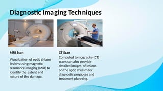 Anatomy, Physiology and lesions of Optic Chaiasma.pptx