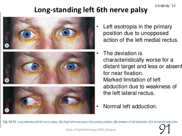 Anatomy & physiology of eom