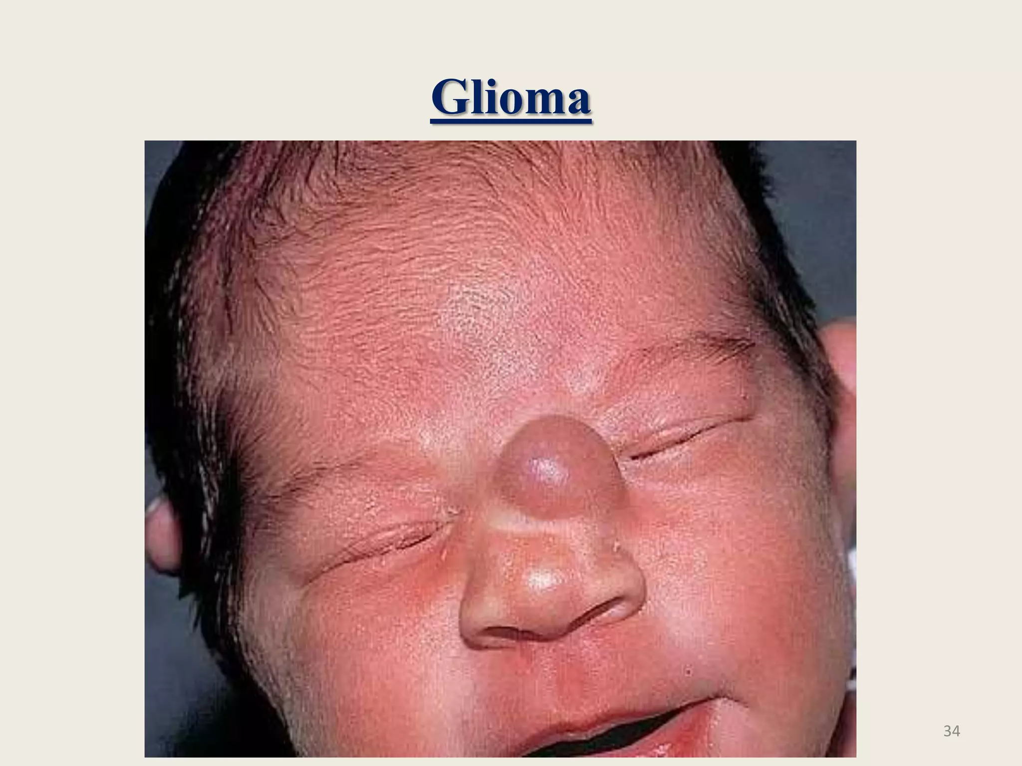 ANATOMY, PHYSIOLOGY & SIGNS SYMPTOMS CONGENITAL ANOMALIES OF NOSE AND ...