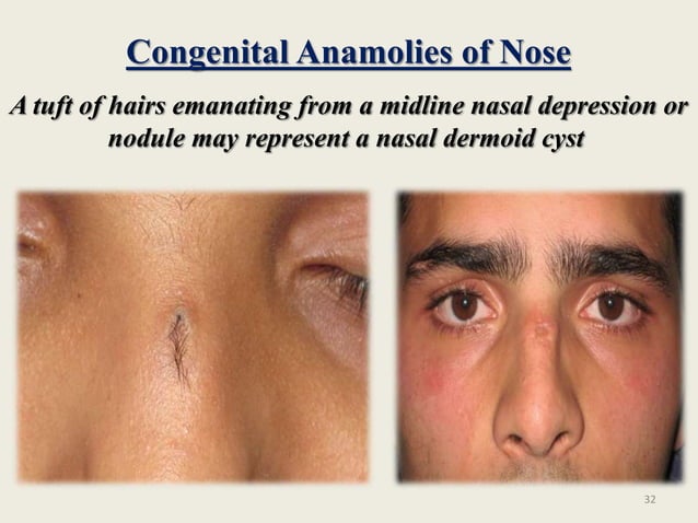 ANATOMY, PHYSIOLOGY & SIGNS SYMPTOMS CONGENITAL ANOMALIES OF NOSE AND ...