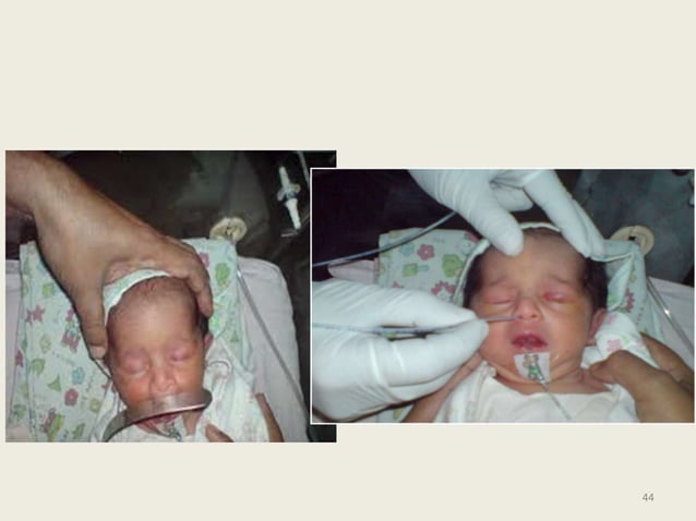 ANATOMY, PHYSIOLOGY & SIGNS SYMPTOMS CONGENITAL ANOMALIES OF NOSE AND ...