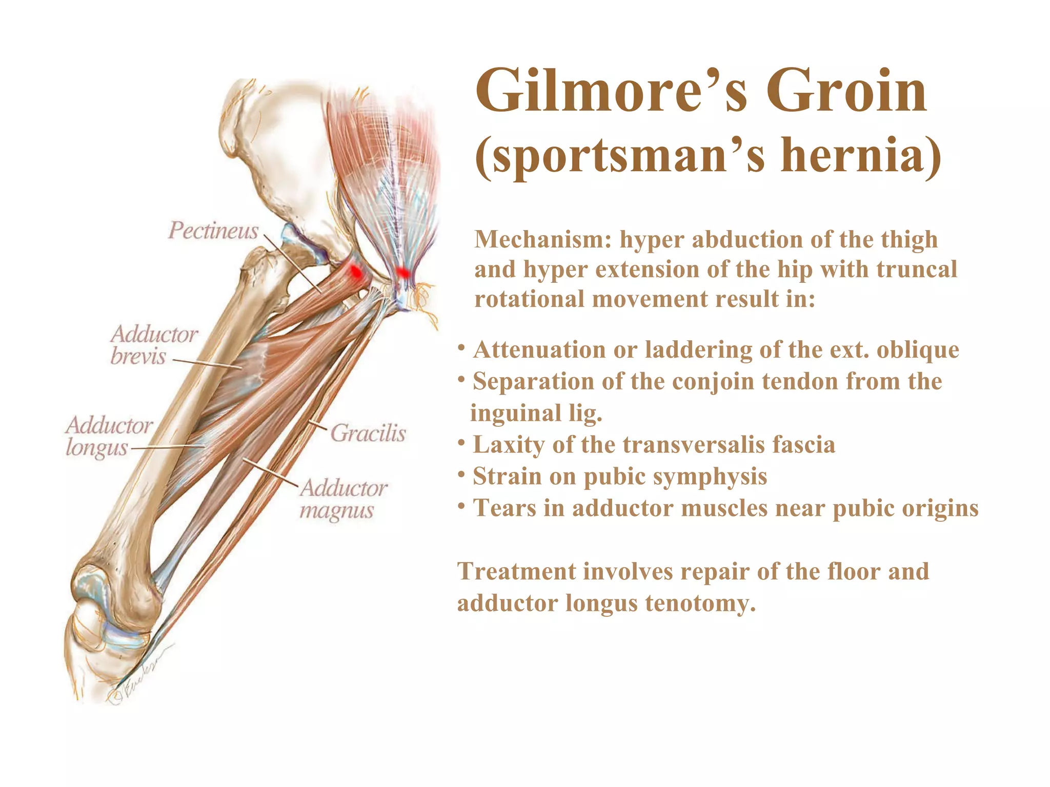 Anatomy and Related Etiology of Groin Pain | PPT