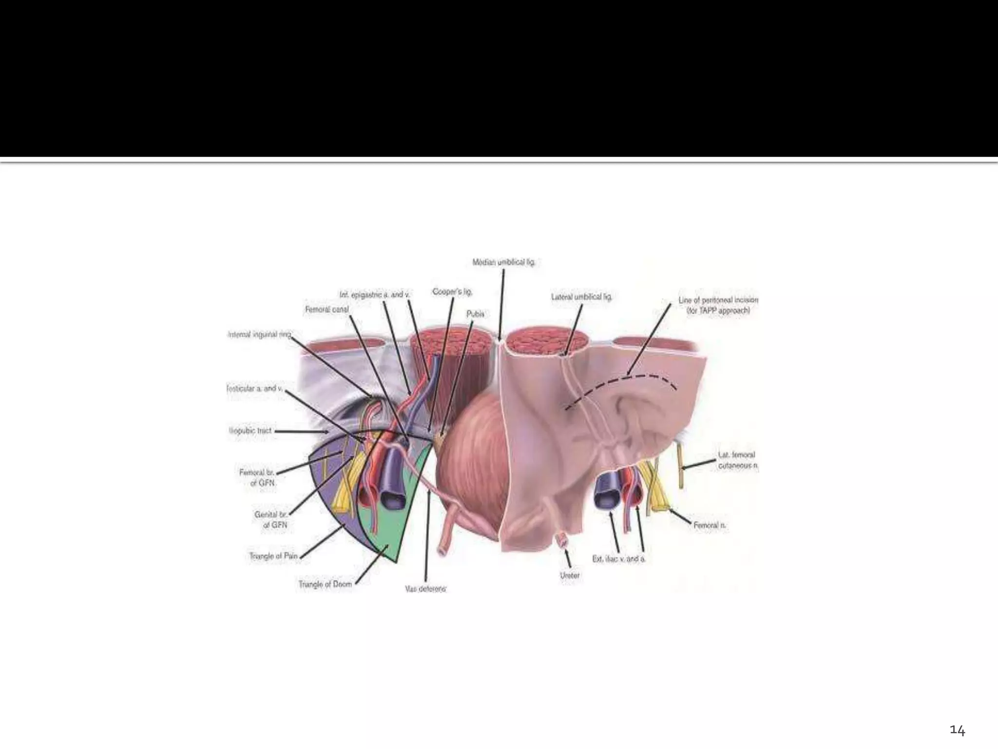 Anatomy & technique of the laparoscopic totally extra peritoneal | PPTX