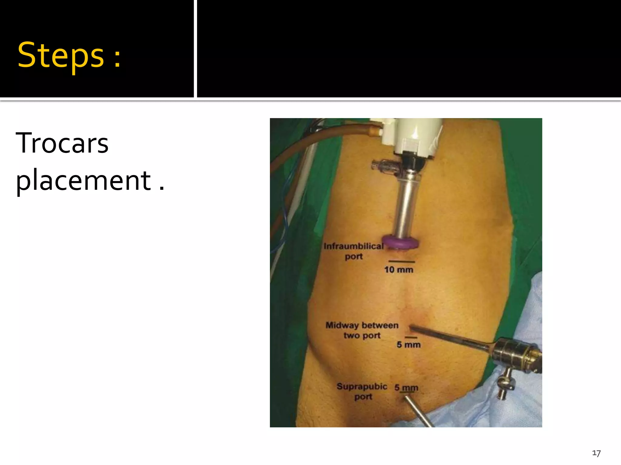 Anatomy & technique of the laparoscopic totally extra peritoneal | PPTX