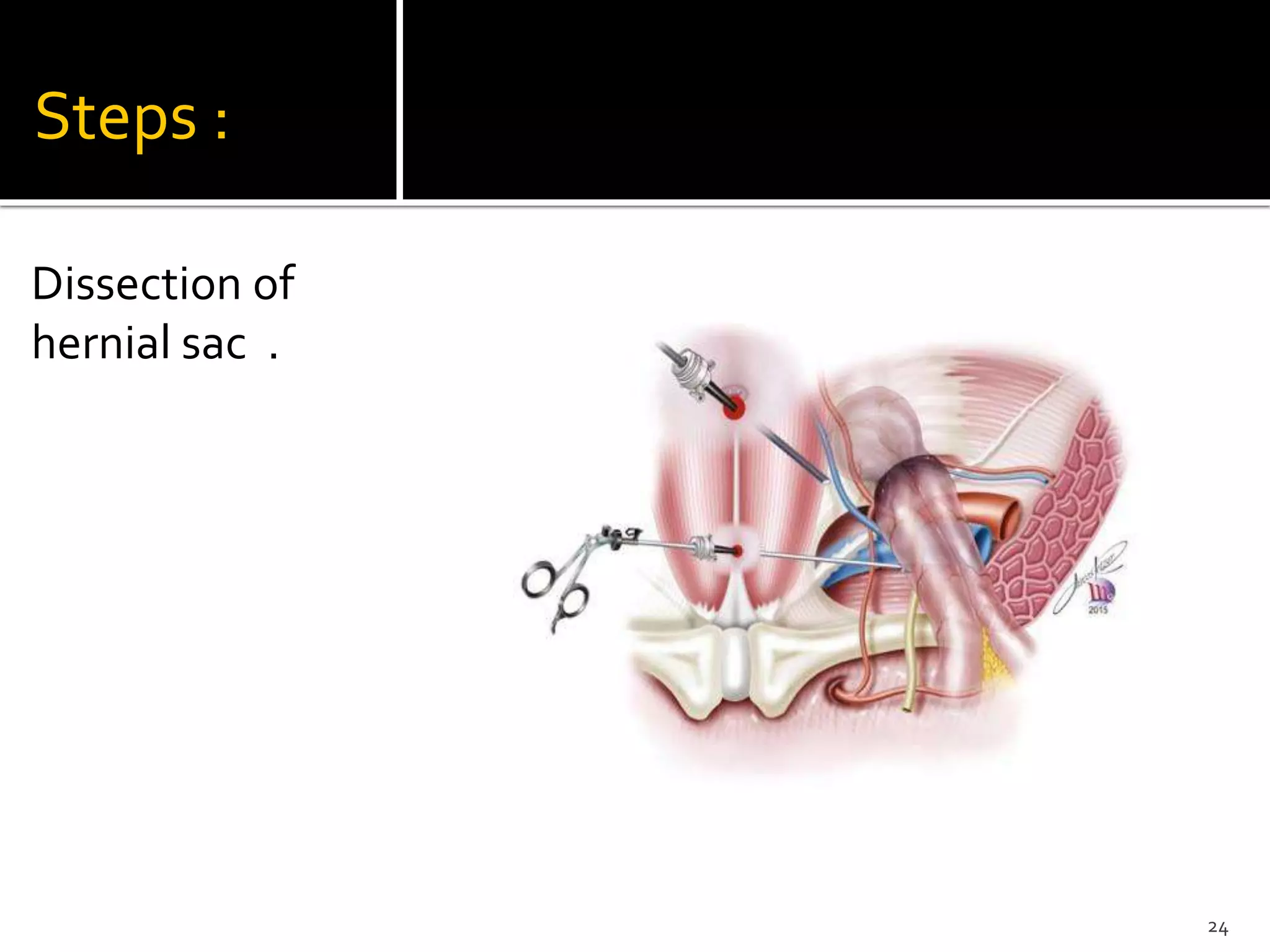 Anatomy & technique of the laparoscopic totally extra peritoneal | PPTX
